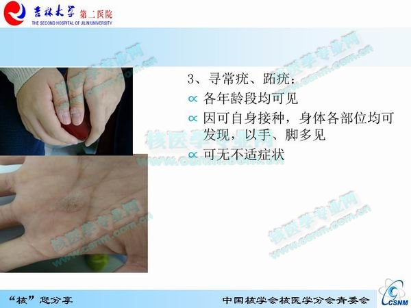 【核您分享】带您了解90Sr-90Y敷贴器 - 核医学专业网