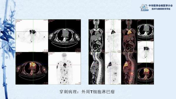 病例18：胸腺瘤PET-CT显像一例-【CSNM继教学组】李凤岐 - 核医学专业网