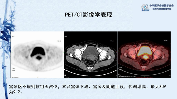 病例72：宫颈癌合并结核一例PET显像一例-【CSNM继教学组】程祝忠 四川省肿瘤医院 - 核医学专业网