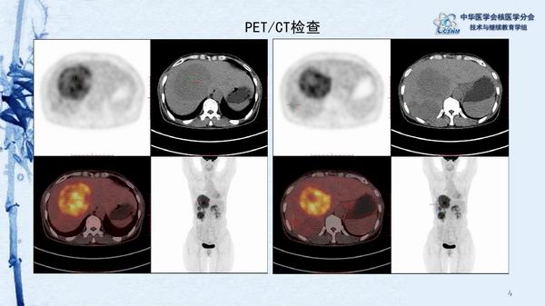 病例77：胰腺神经内分泌肿瘤PET-CT显像一例-【CSNM继教学组】缪蔚冰 福建医科大学附属第一医院 - 核医学专业网