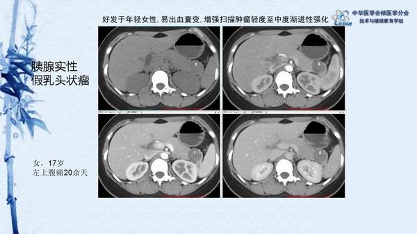 病例77：胰腺神经内分泌肿瘤PET-CT显像一例-【CSNM继教学组】缪蔚冰 福建医科大学附属第一医院 - 核医学专业网