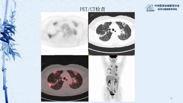 病例78：肺MALT淋巴瘤 PET-CT显像一例-【CSNM继教学组】郑山 福建医科大学附属第一医院 - 核医学专业网
